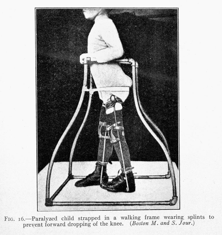 A History of Polio: A 20th-Century Epidemic