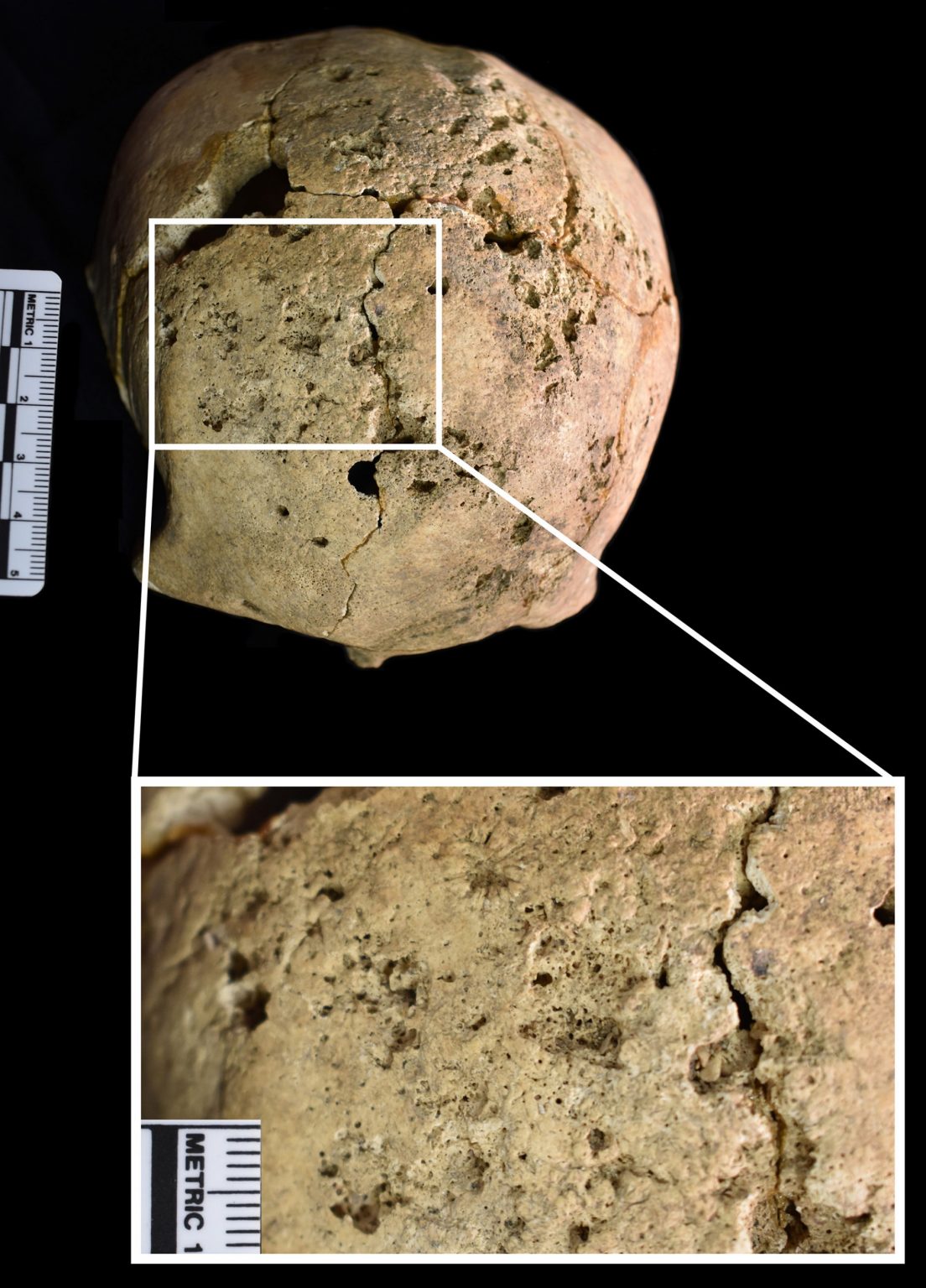Ancient Diseases: Traces of Suffering in the Bones Brewminate: A Bold ...