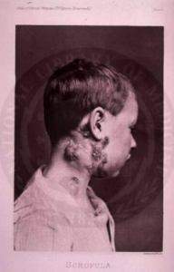 Morbus Regius: The 'King's Evil' and a Medieval Disease