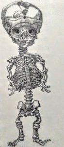 Pregnancy and Rickets in Victorian-Era Britain